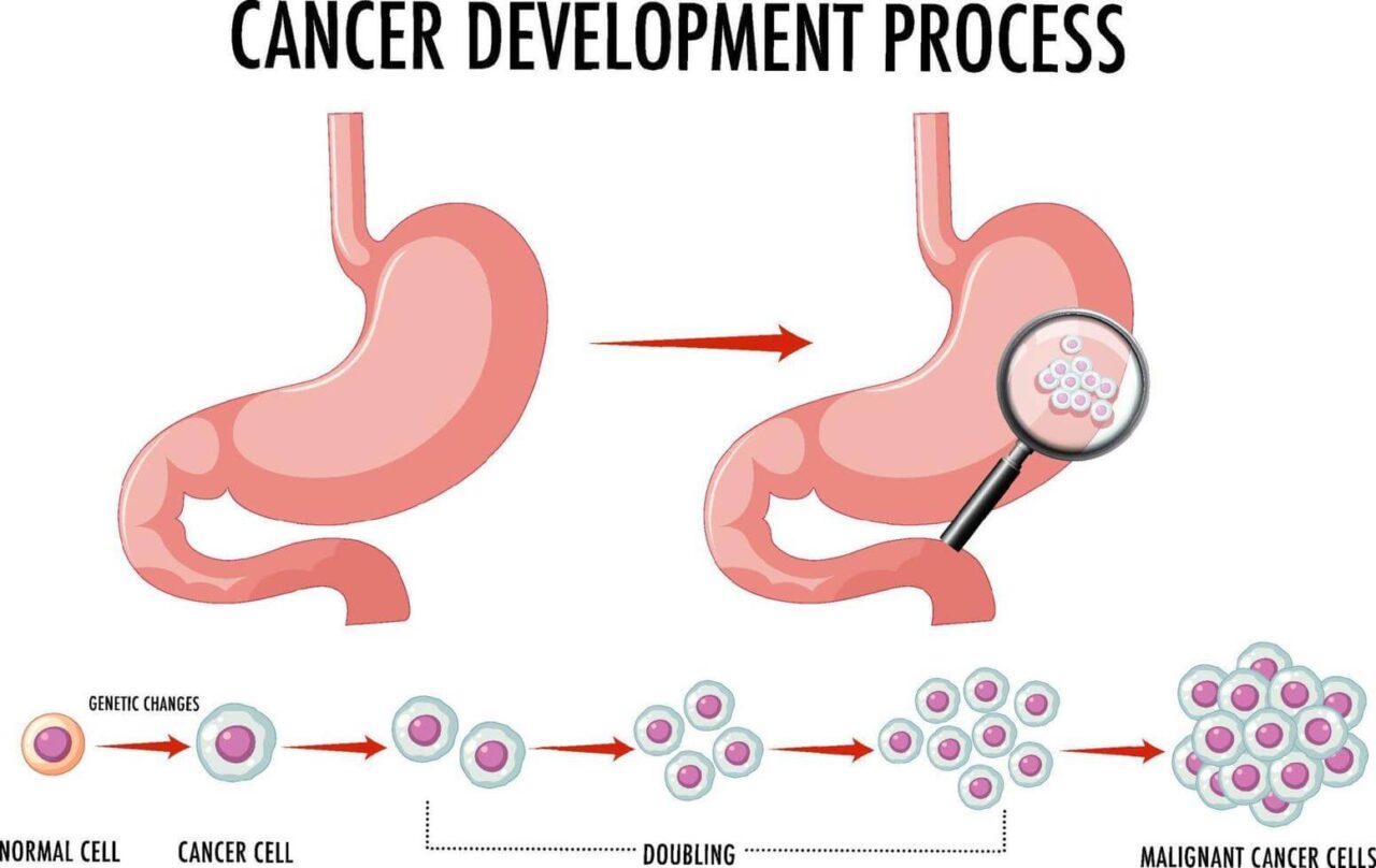 Gut Health and Cancer: Understanding the Connection